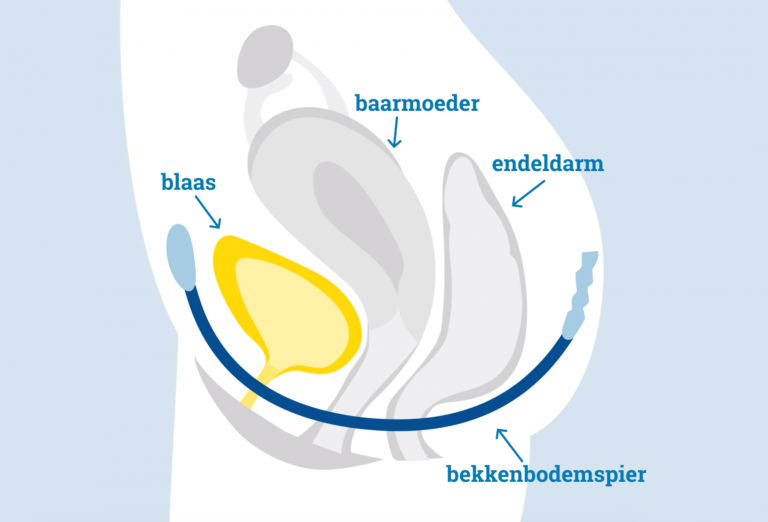 afbeelding urineverlies en verzakking | De Gynaecoloog